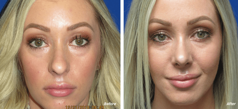 Rhinoplasty for Wide Nose Bridges