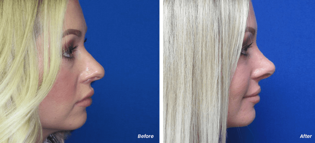 Rhinoplasty for Wide Nose Bridges