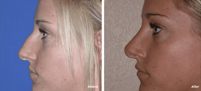 Rhinoplasty for Wide Nose Bridges