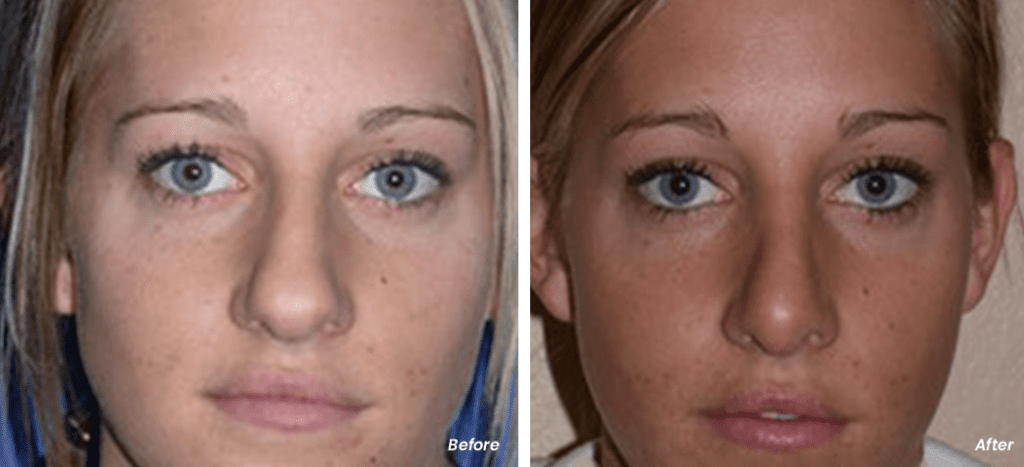 Rhinoplasty for Wide Nose Bridges